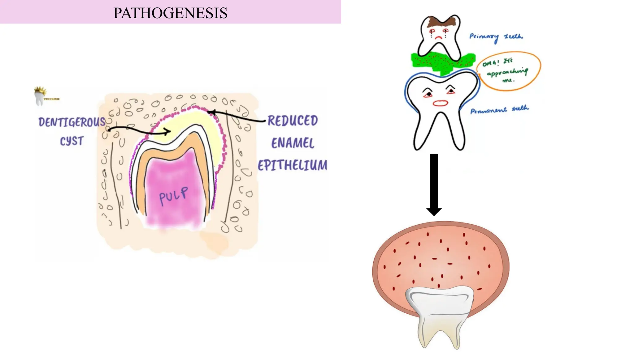 DENTIGEROUS CYST (FOLLICULAR CYST) PPT | PPTX