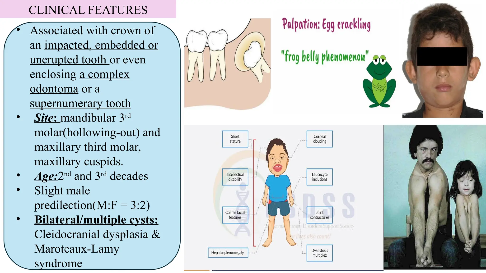DENTIGEROUS CYST (FOLLICULAR CYST) PPT | PPTX | Dental Health ...