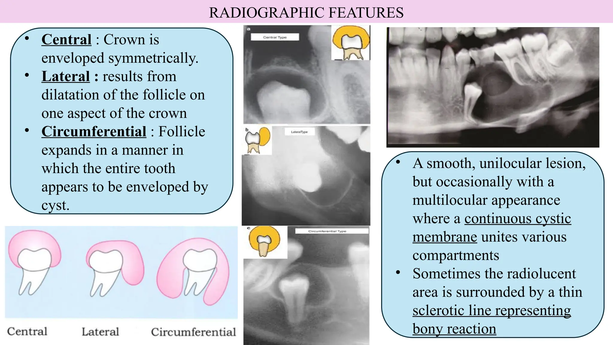 DENTIGEROUS CYST (FOLLICULAR CYST) PPT | PPTX