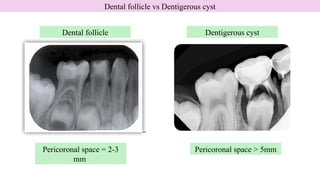 DENTIGEROUS CYST (FOLLICULAR CYST) PPT | PPTX | Dental Health ...