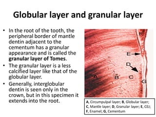 Interglobular Dentin
