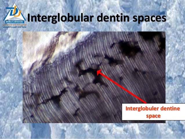 Interglobular Dentin