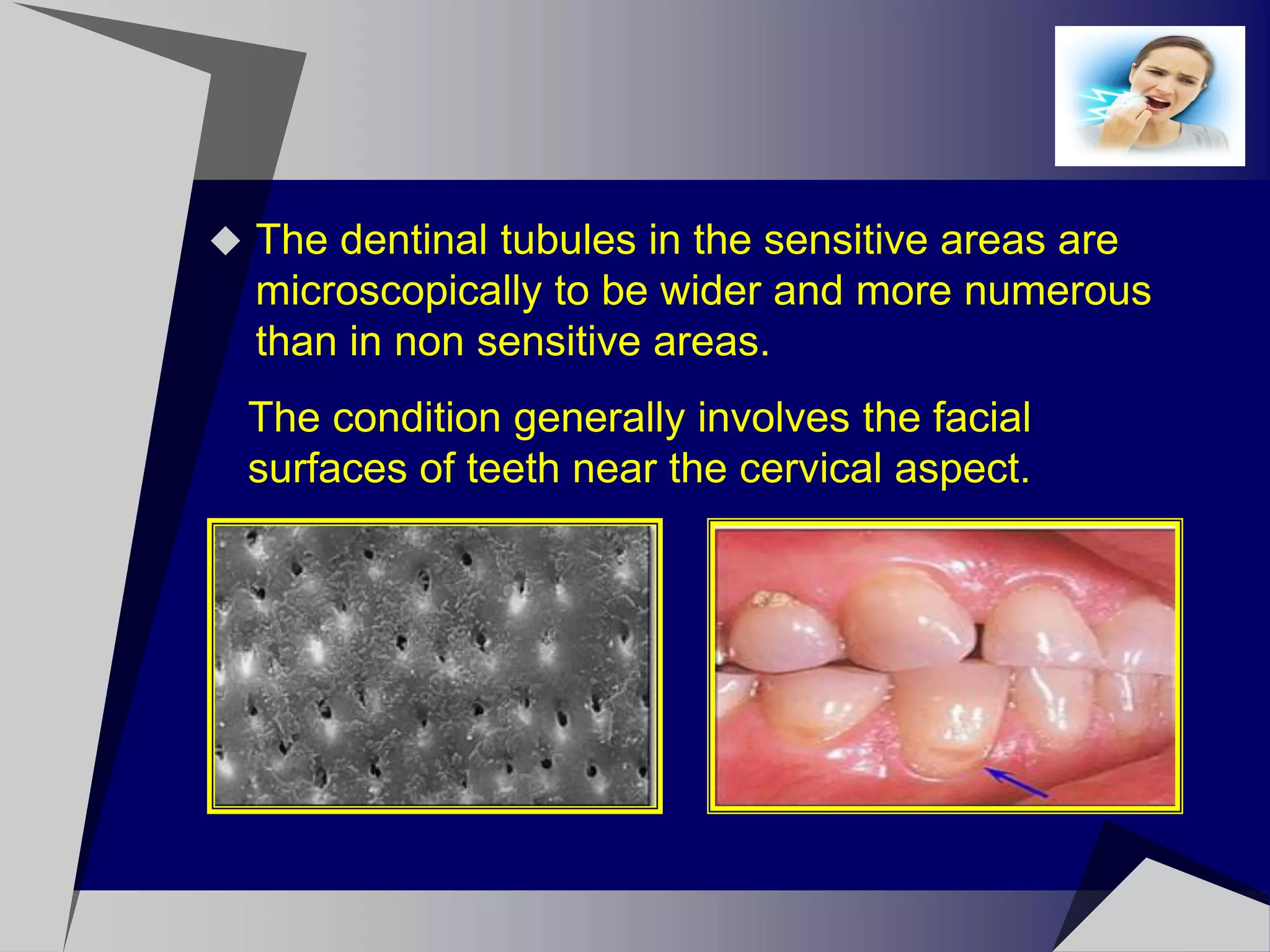 Dentinal hypersensitivity.pdf