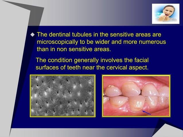 Dentinal hypersensitivity.pdf
