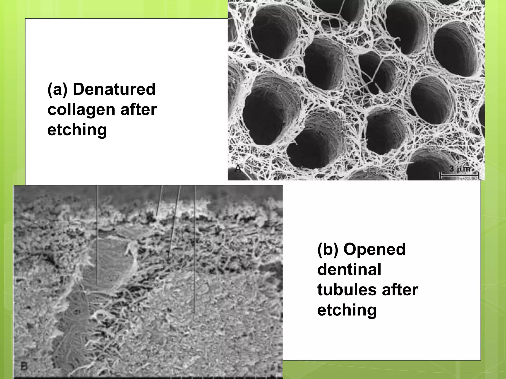 Dentin bonding agents | PPTX