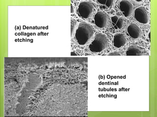 Dentin bonding agents | PPTX