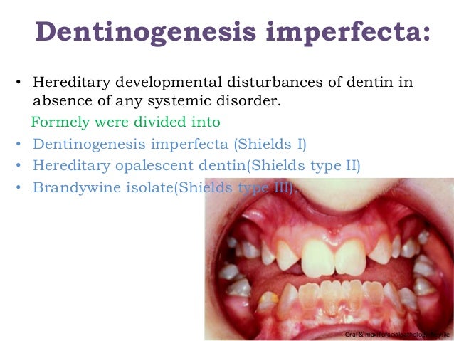 Dentin Dysplasia Vs Dentinogenesis Imperfecta