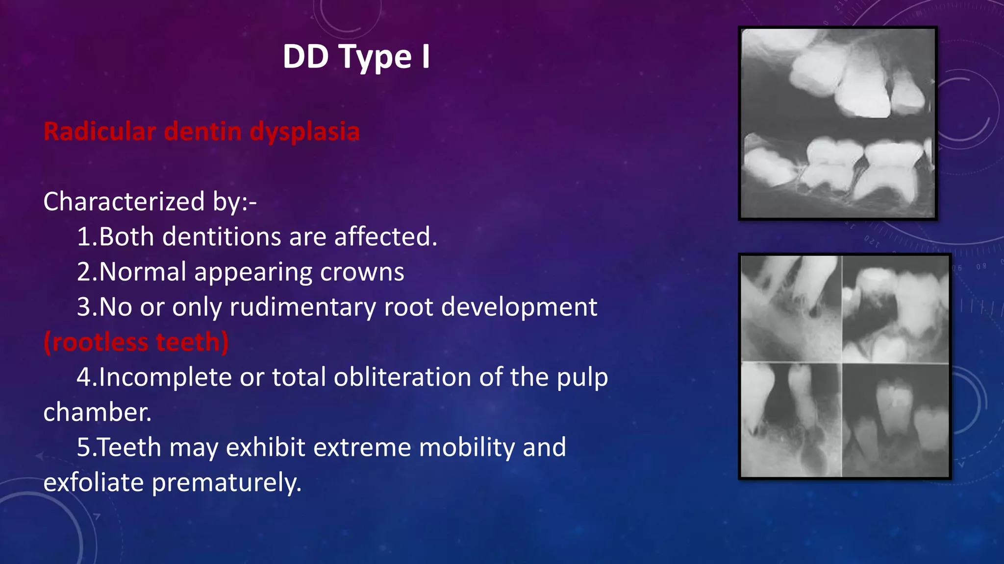 Dentin Dysplasia | PPTX