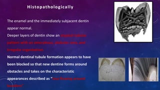 Dentin Dysplasia | PPTX