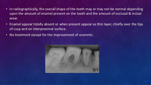 Dentin Dysplasia Vs Dentinogenesis Imperfecta
