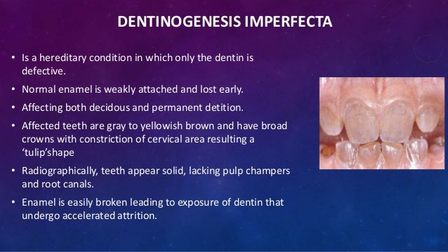 Dentin Dysplasia