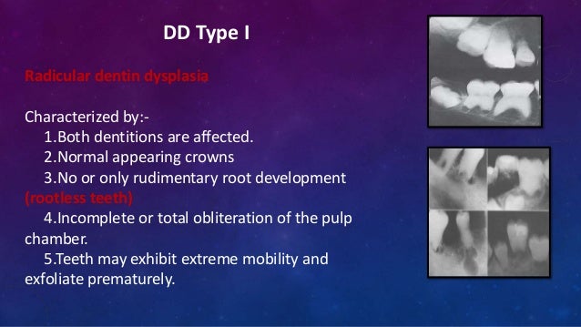 Dentin Dysplasia