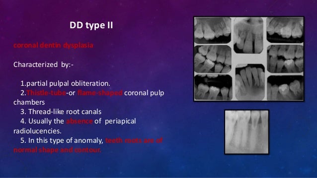Dentin Dysplasia