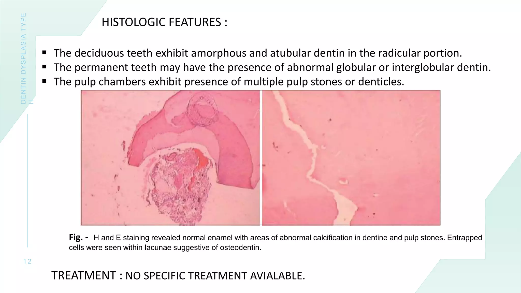 Dentin dysplasia | PPTX | Dental Health | Diseases and Conditions