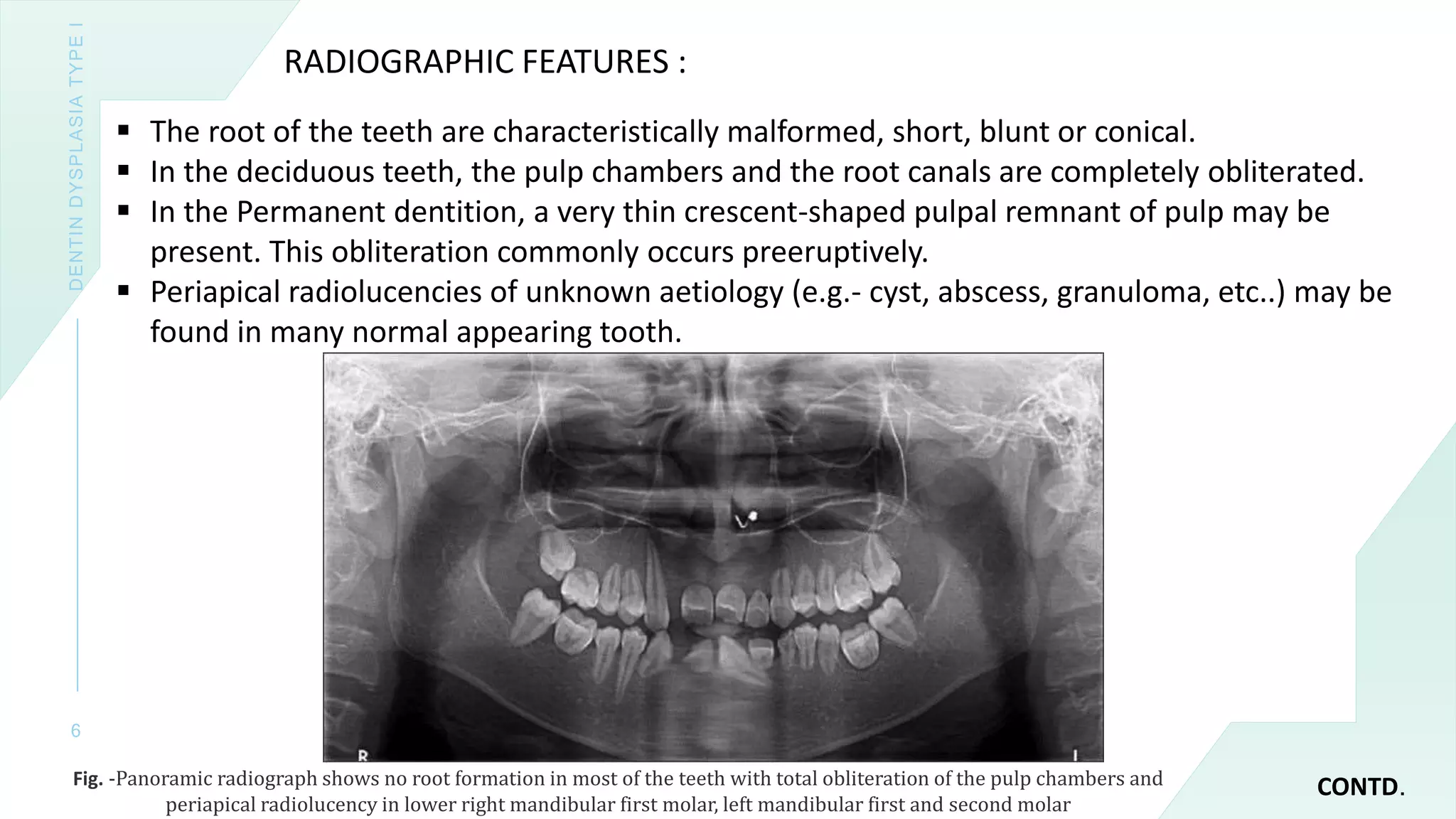 Dentin dysplasia | PPTX