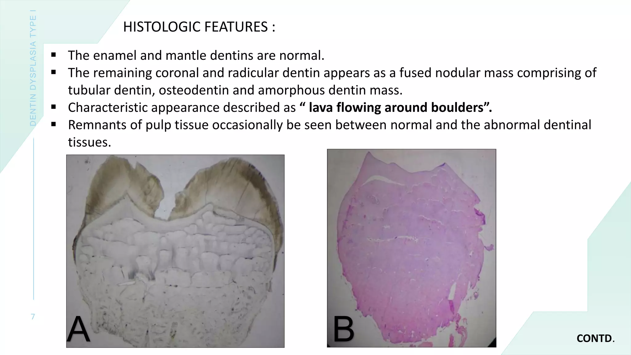 Dentin dysplasia | PPTX