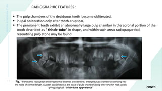 Dentin dysplasia | PPTX