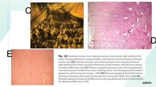 Dentin dysplasia | PPTX