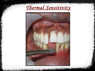 Dentine hypersensitivity / /certified fixed orthodontic courses by In…