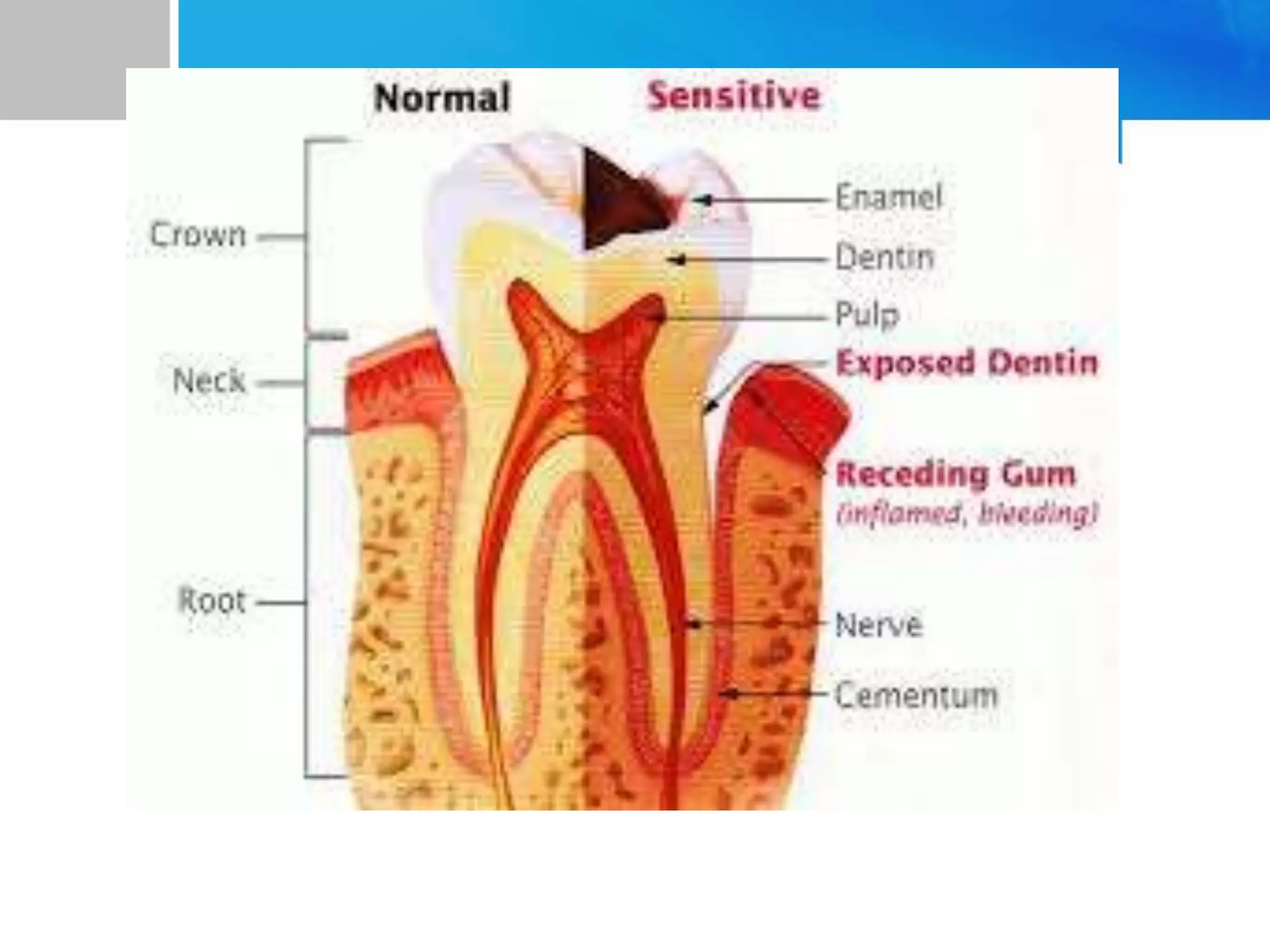 Dentin hypersensitivity | PPTX