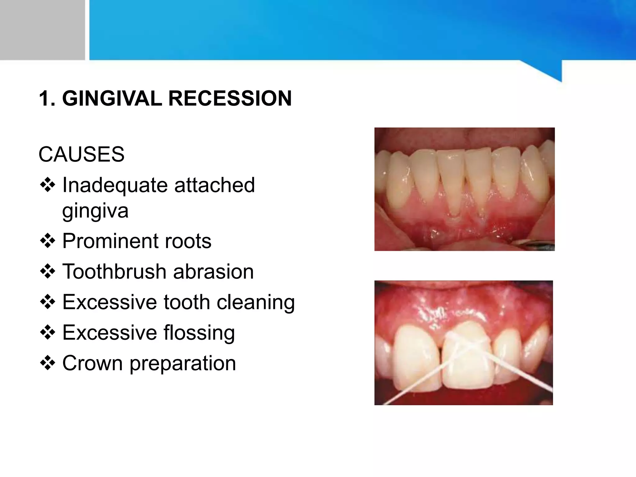 Dentin hypersensitivity | PPTX