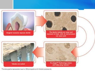 Dentin hypersensitivity | PPT