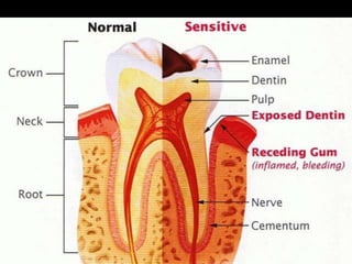 Dentin hypersensitivity | PPTX | Dental Health | Diseases and Conditions