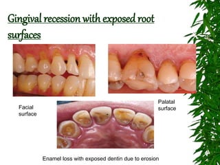 dentin hypersensitivity.ppt