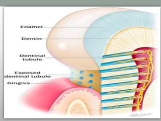 Dentinal hypersenstivity | PPTX