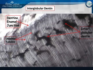 Interglobular Dentin