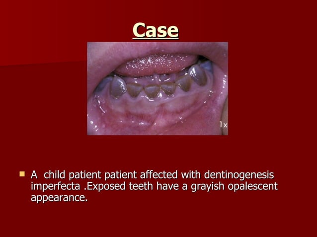 Dentinogenesis Imperfecta | PPT