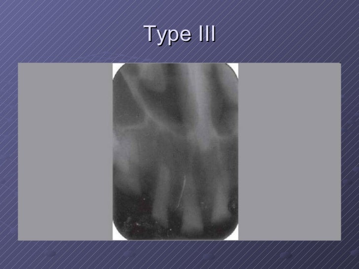 Dentinogenesis imperfecta