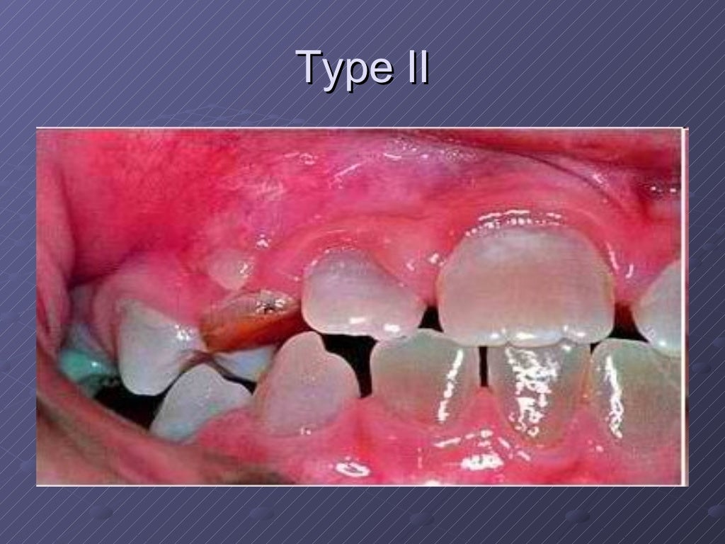 Dentinogenesis imperfecta