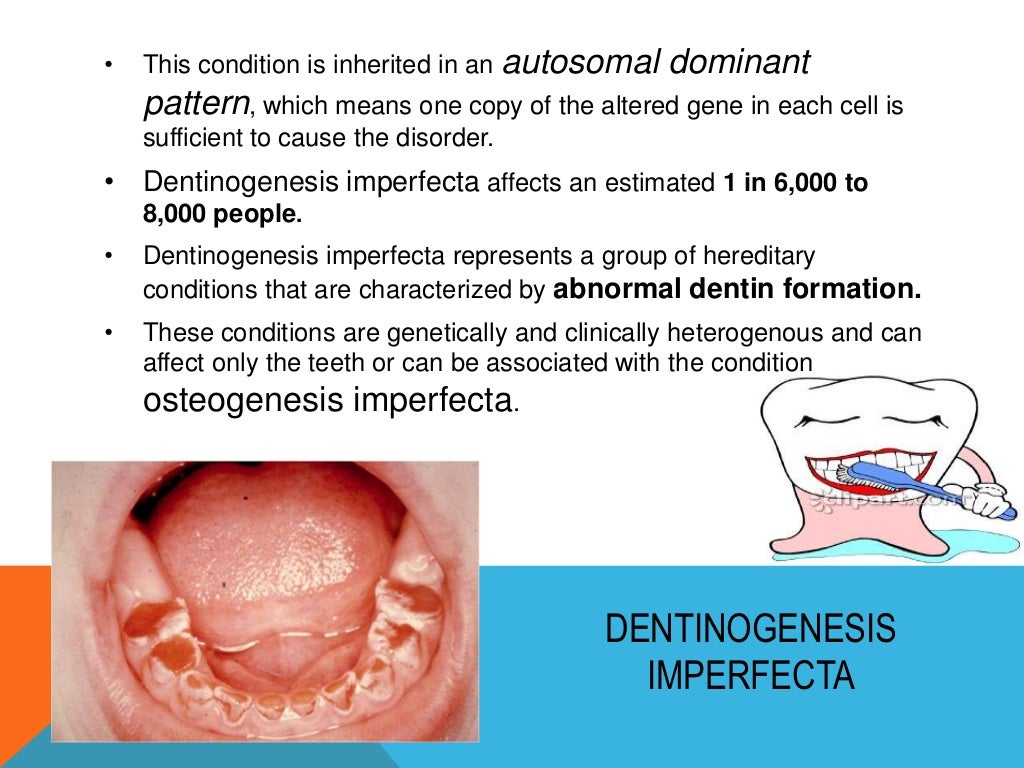 Dentinogenesis imperfecta