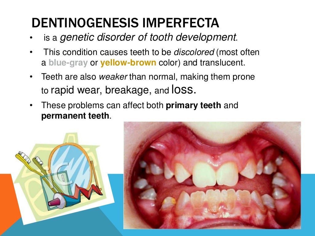Dentinogenesis imperfecta