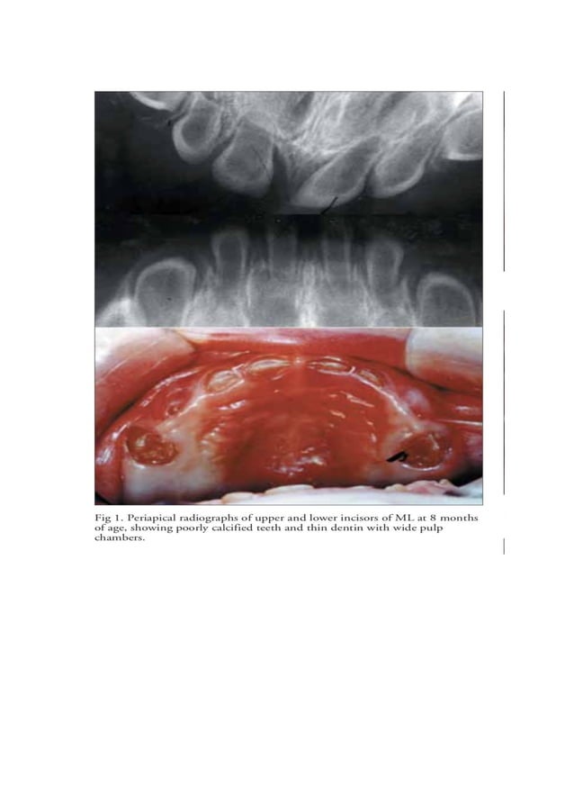 DENTINOGENESIS IMPERFECTA in adult tooth | PDF