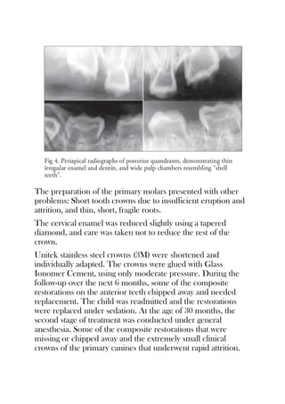 DENTINOGENESIS IMPERFECTA in adult tooth | DOCX