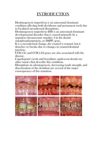 DENTINOGENESIS IMPERFECTA in adult tooth | PDF