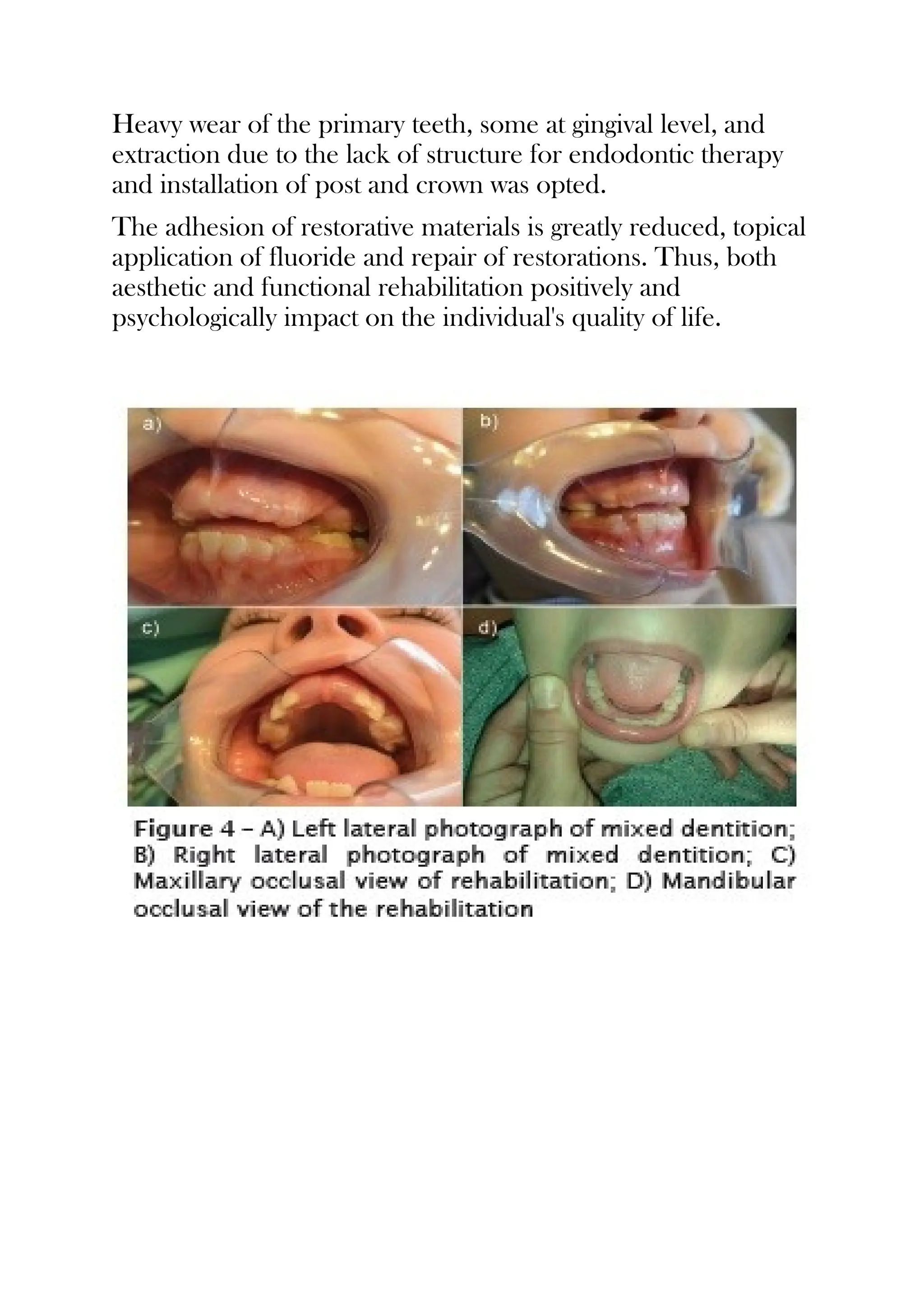 DENTINOGENESIS IMPERFECTA in adult tooth | DOCX
