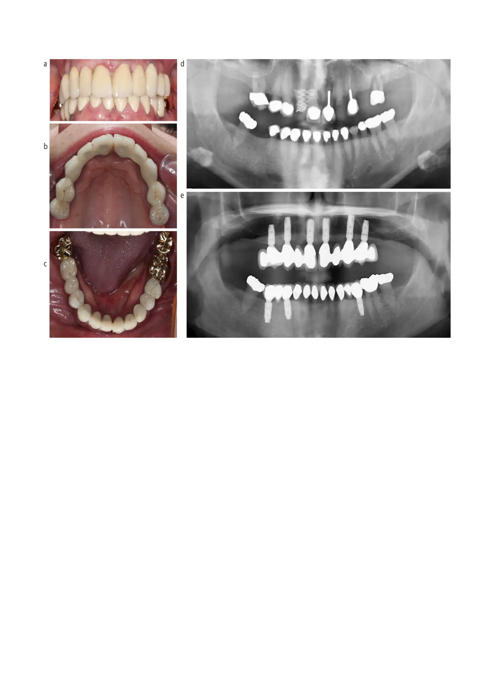 DENTINOGENESIS IMPERFECTA in adult tooth | DOCX