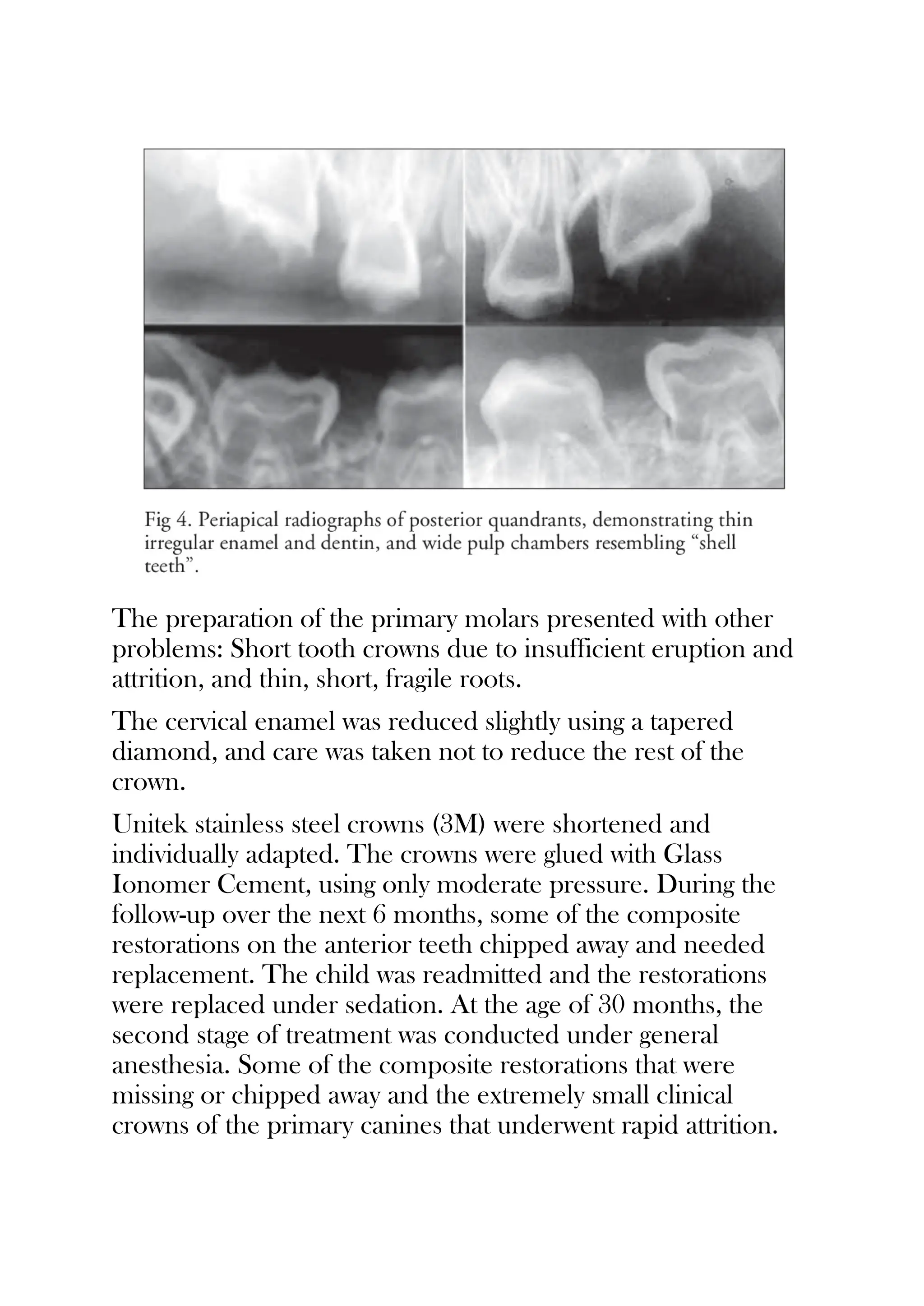DENTINOGENESIS IMPERFECTA in adult tooth | DOCX