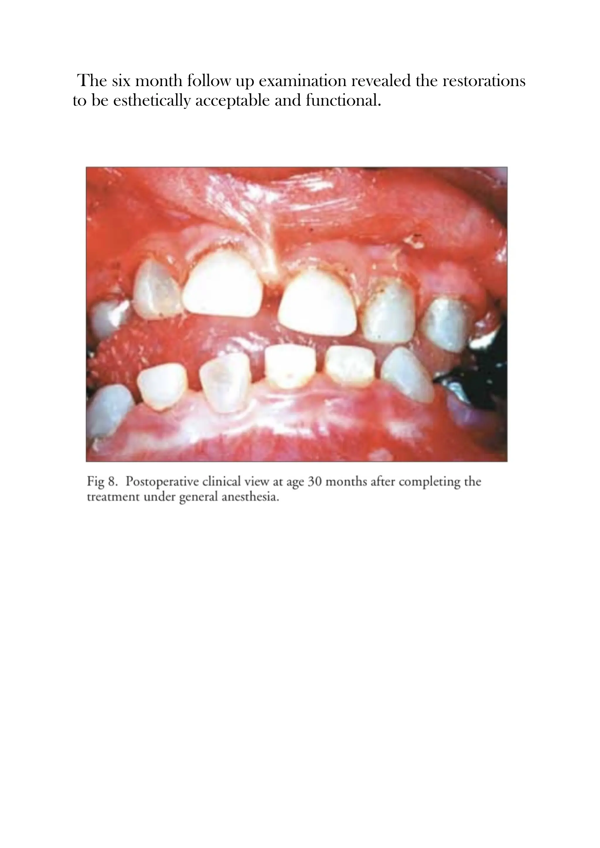 DENTINOGENESIS IMPERFECTA in adult tooth | DOCX