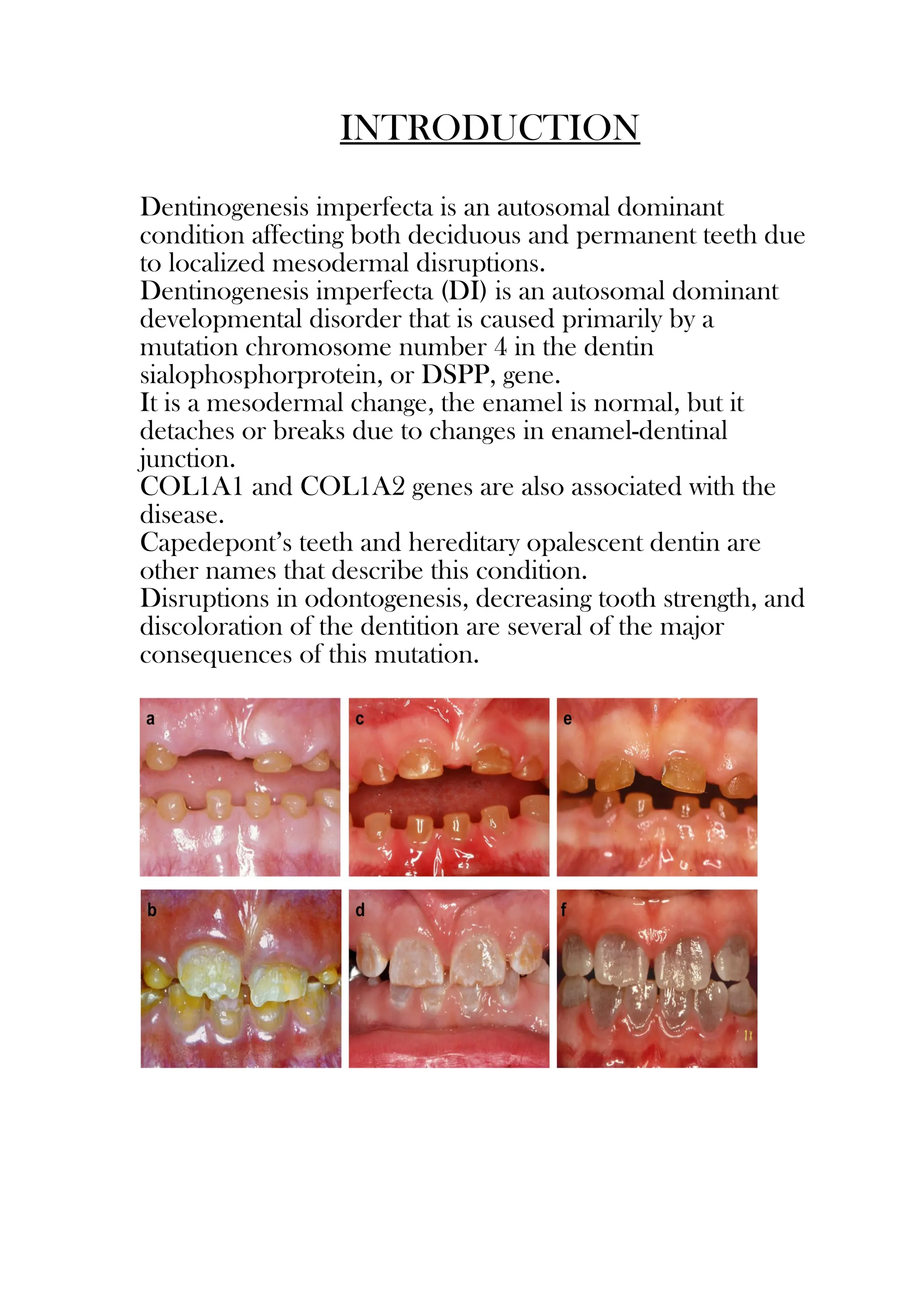 DENTINOGENESIS IMPERFECTA in adult tooth | DOCX