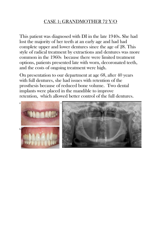 DENTINOGENESIS IMPERFECTA in adult tooth | PDF