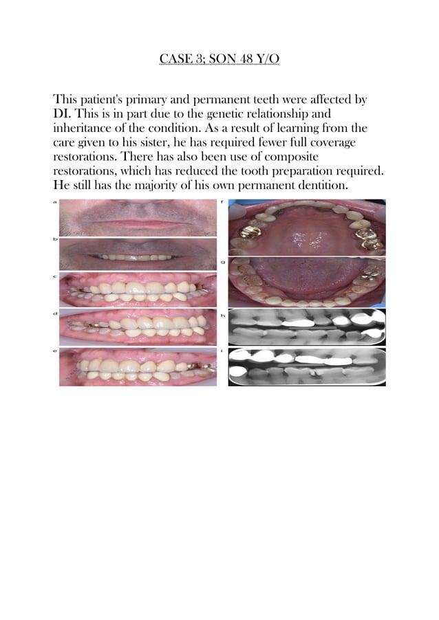DENTINOGENESIS IMPERFECTA in adult tooth | PDF