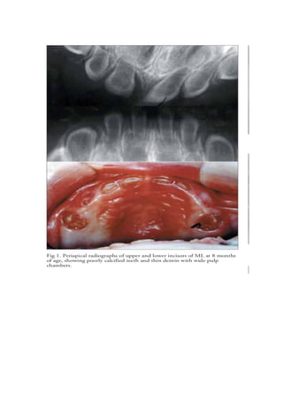 DENTINOGENESIS IMPERFECTA in adult tooth | PDF