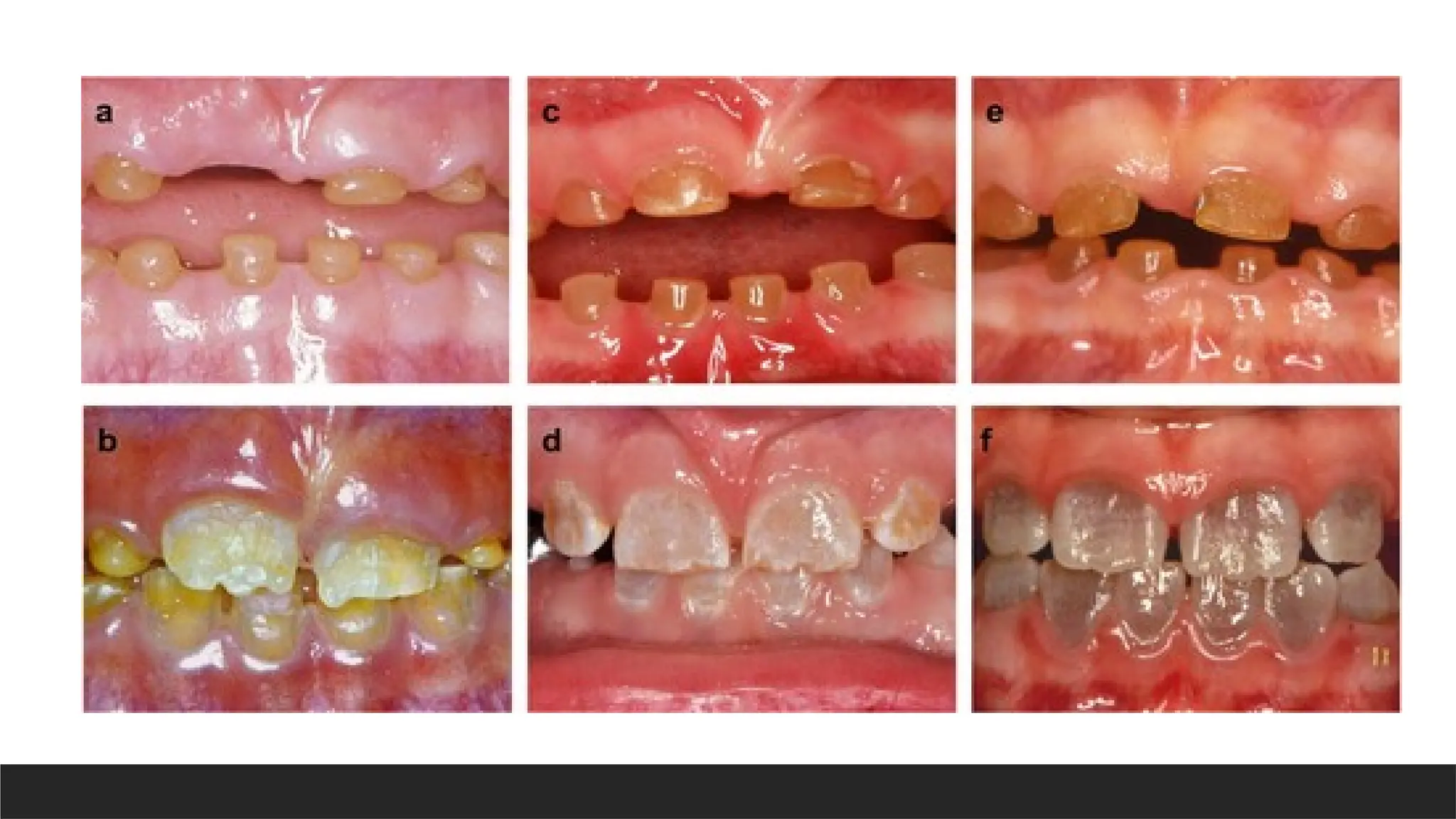 Dentinogenesis Imperfecta dental anomaly | PPT