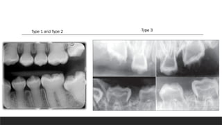 Dentinogenesis Imperfecta dental anomaly | PPTX