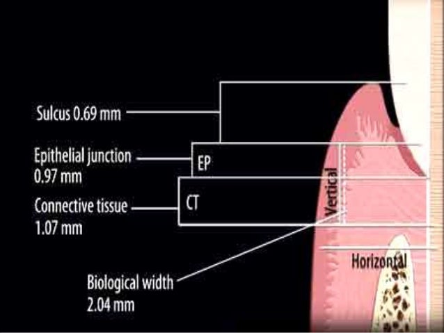 Gingival Sulcus Depth Polymeric Nanotechnologies For The Treatment Of