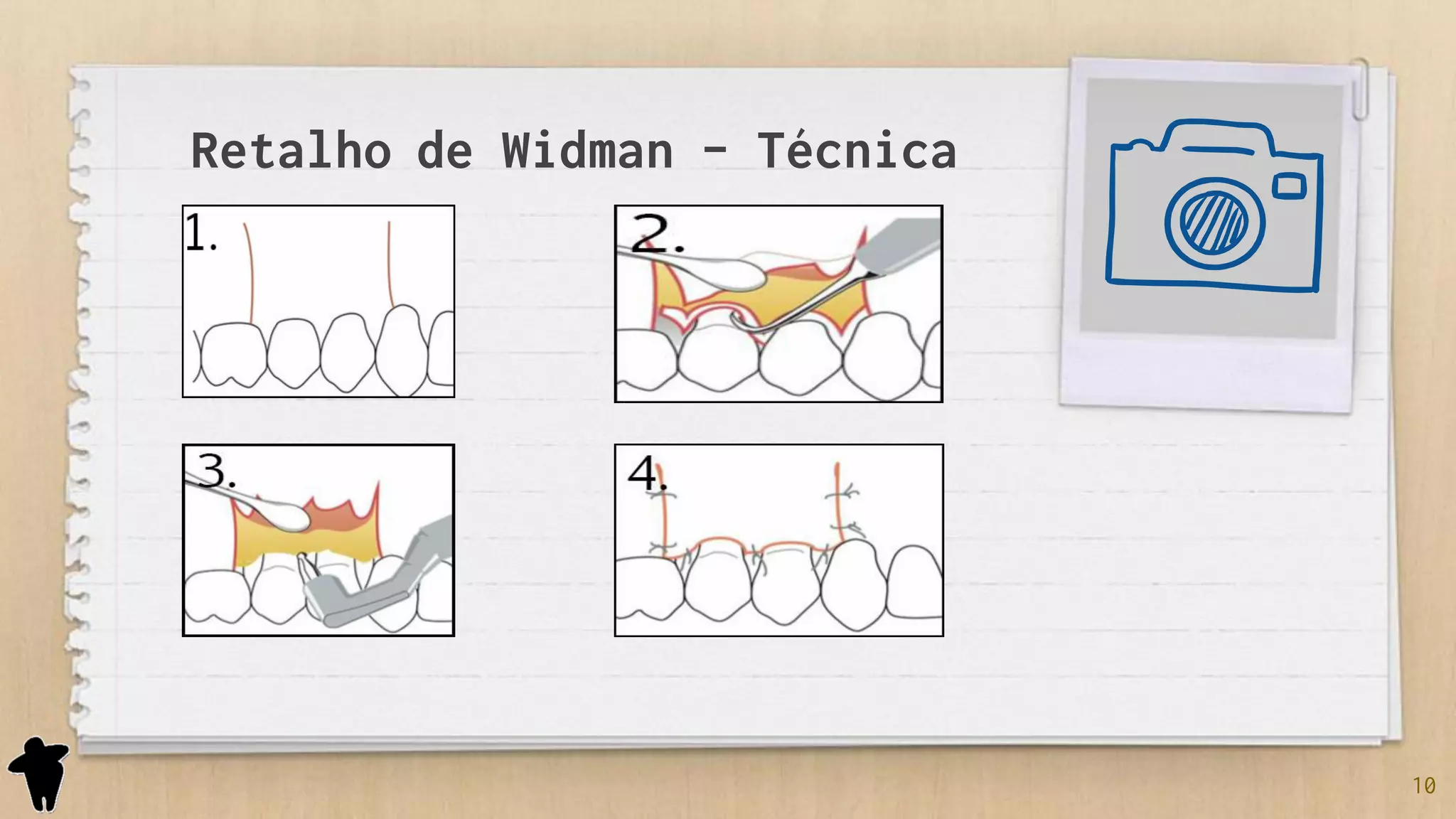 Resumo de Periodontia - Retalho de Widman, Widman Modificado, Kirkland ...
